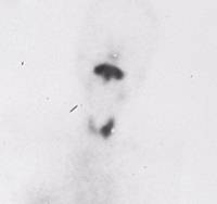 Head and Neck | SkeletalScintigraphy.com